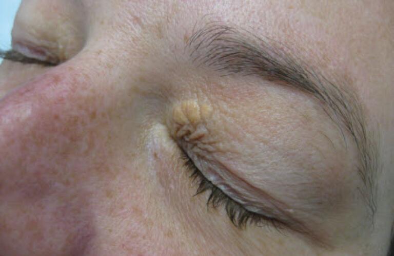 Signs of Very High Triglycerides