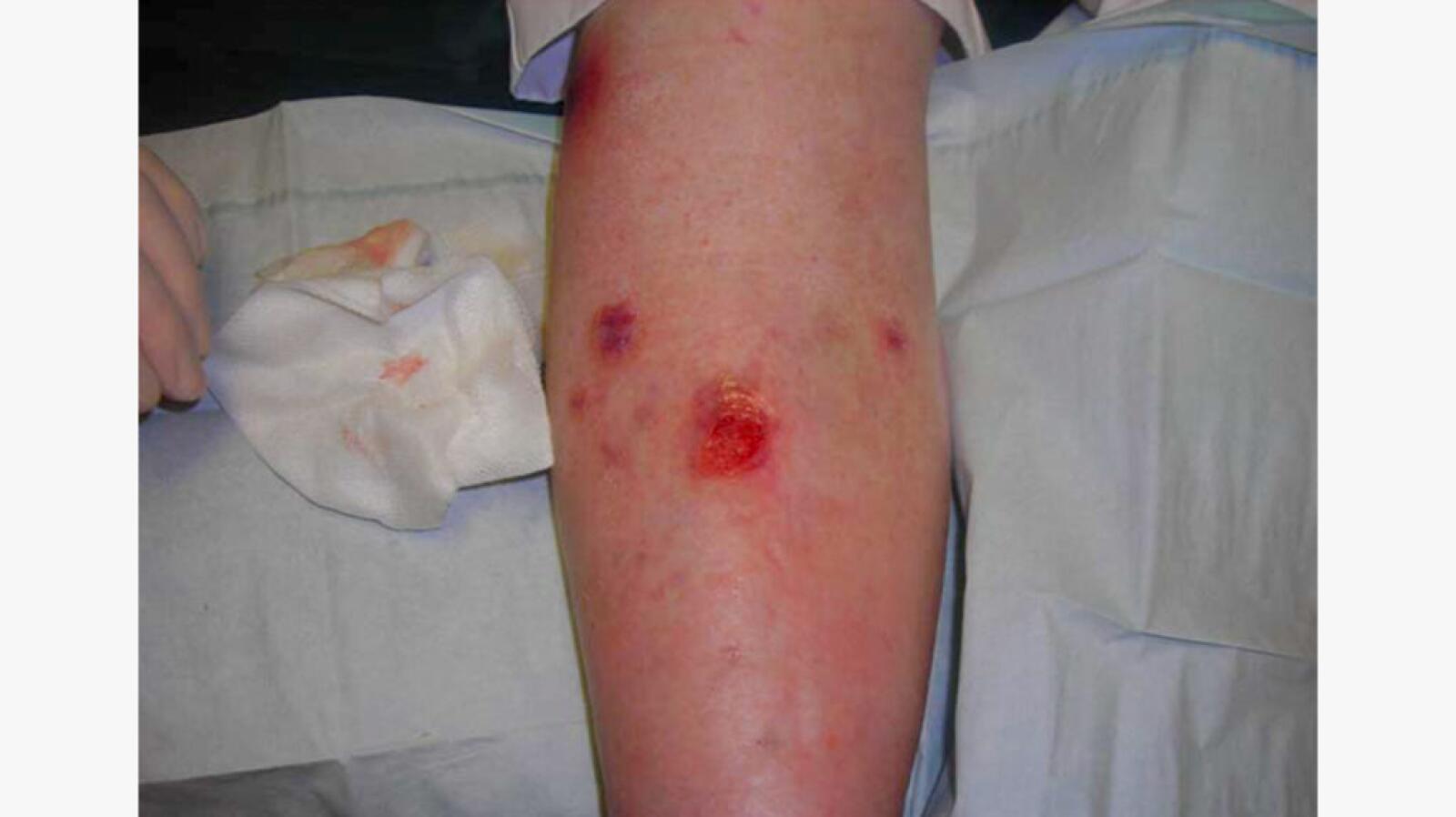 Types of Ulcers: Causes, Symptoms, and Treatments