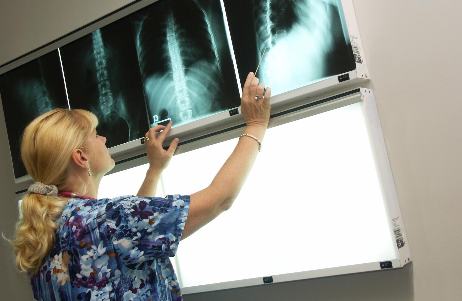 Small Cell Lung Cancer Stages | Limited Vs. Extensive Stage Lung Cancer