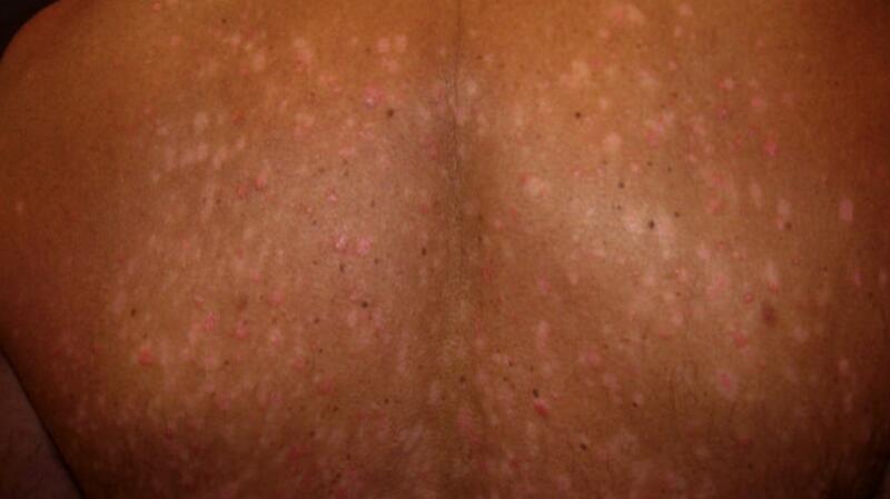 hypopigmentation spots