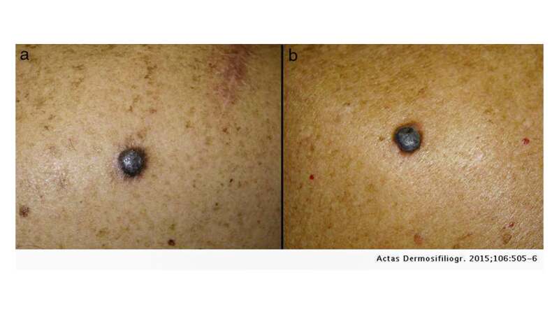 Nodular Melanoma Pictures: Symptoms, Treatment, and More
