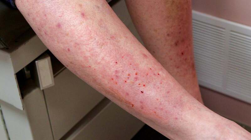 Atopic Dermatitis Vs Contact Dermatitis Whats The Difference