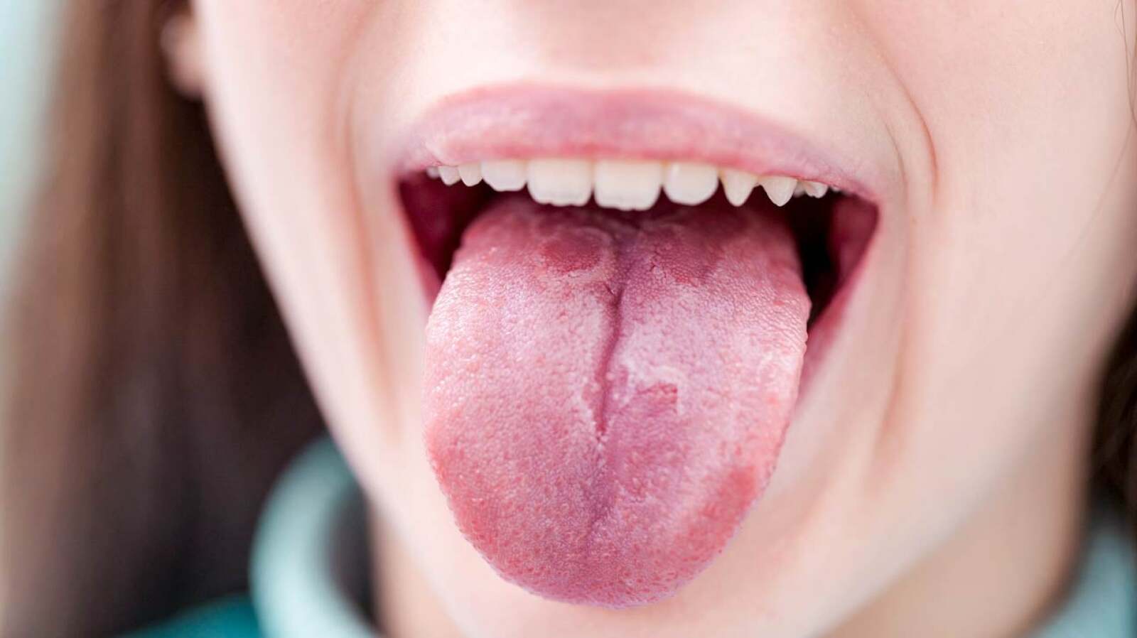 Geographic Tongue: Pictures, Symptoms, Causes, Treatments