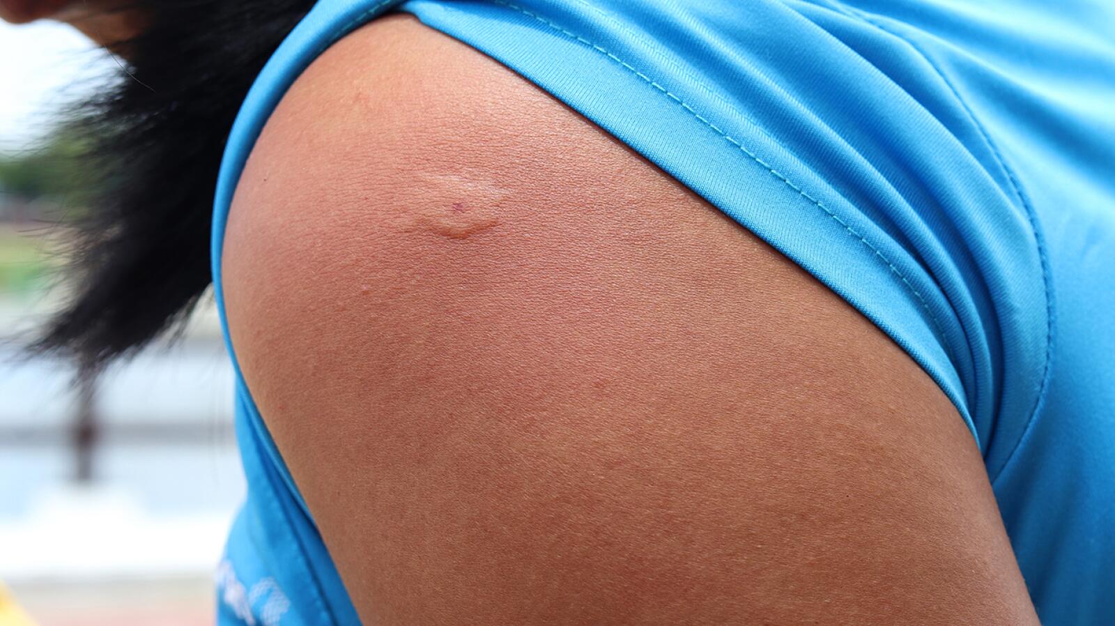 Bug Bite Pictures: Symptoms, Identification, Treatment, and More