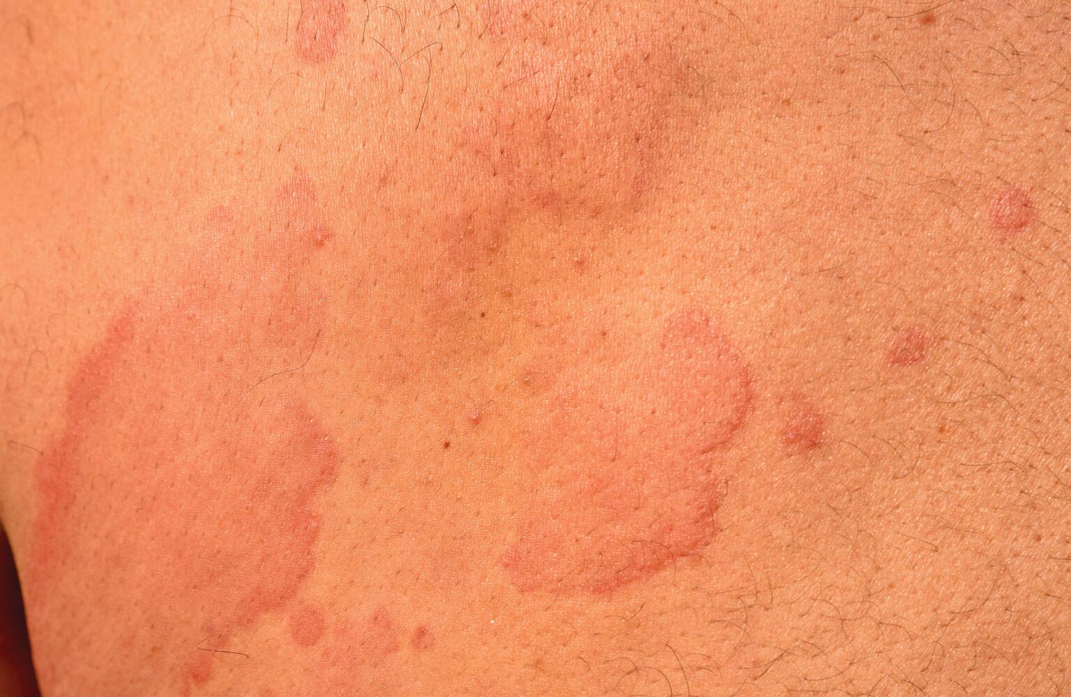 Chronic Hives Chronic Idiopathic Urticaria