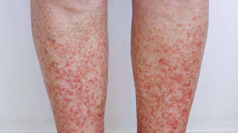 Sun Rash: Types, Causes, and Treatments