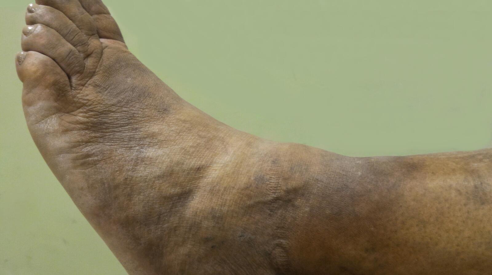 8 Surprising Cellulitis Facts | Is Cellulitis Contagious?