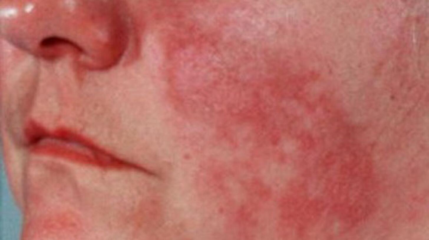 12 Symptoms of Lupus 12 Symptoms of Lupus