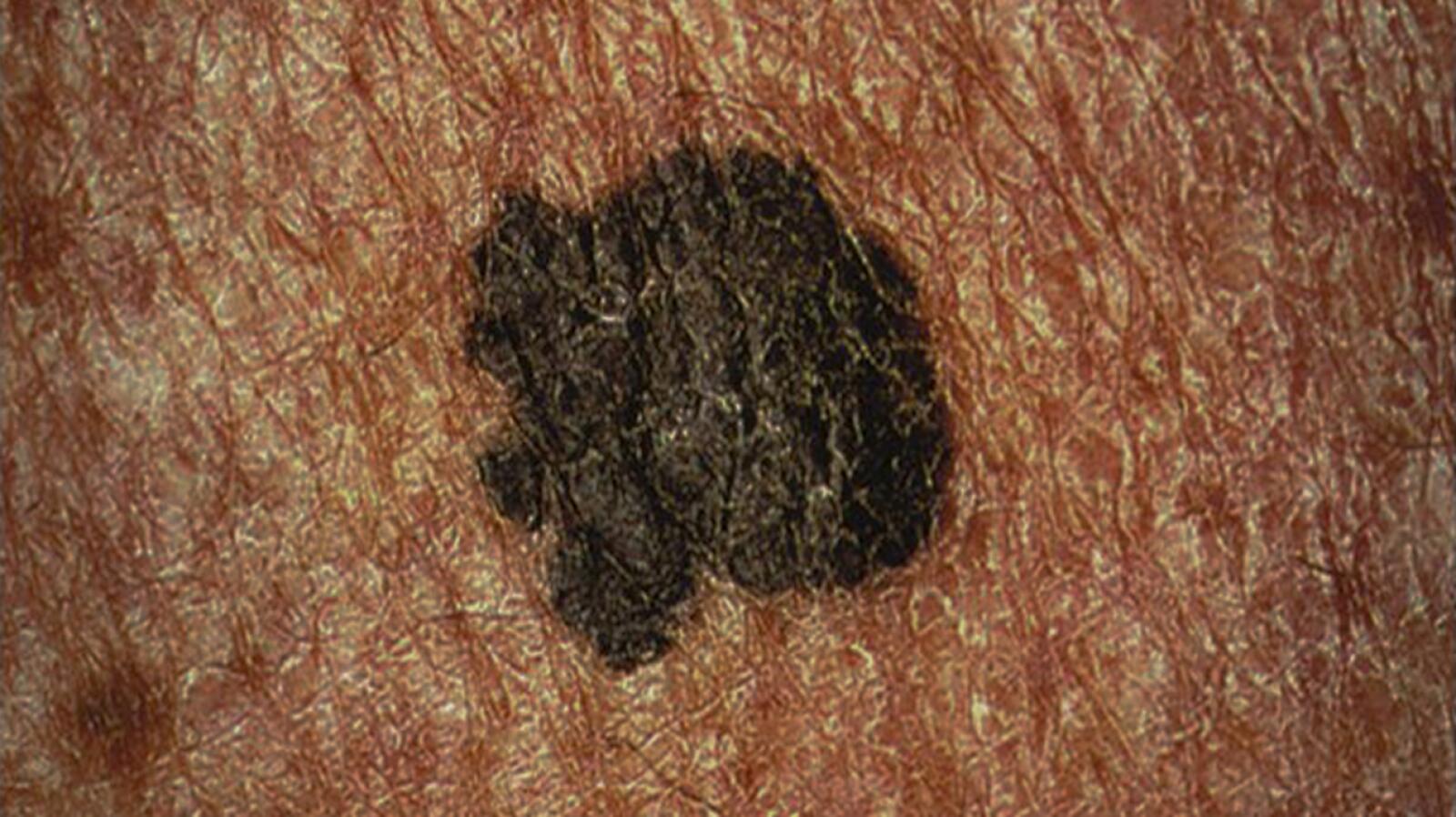 What Does Skin Cancer Look Like? Signs, Pictures, and More