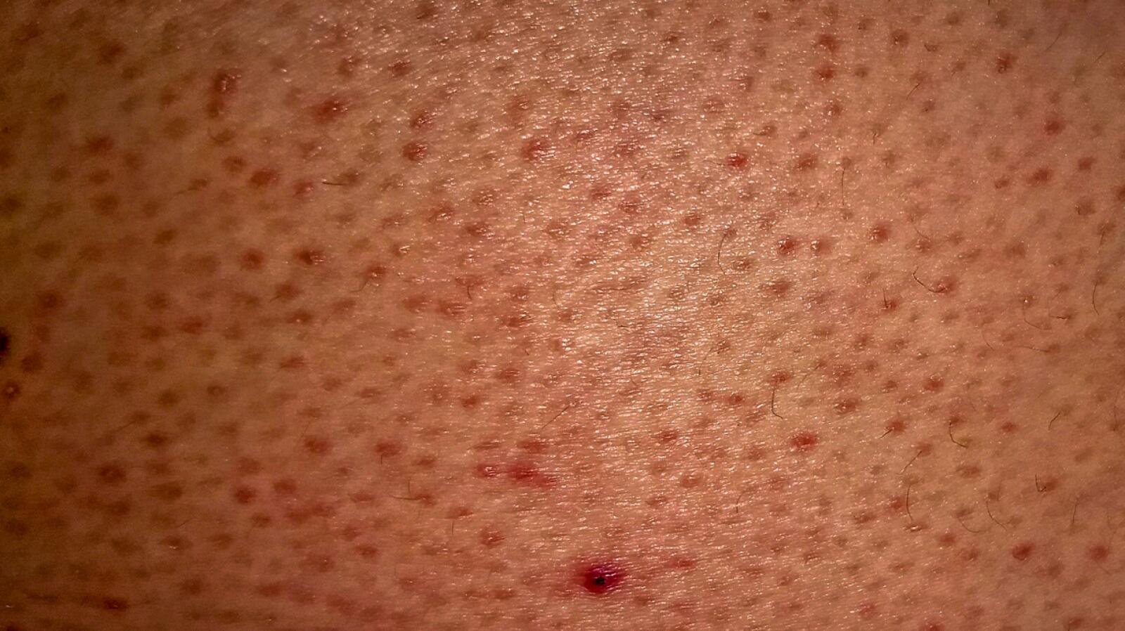 Keratosis Pilaris Symptoms Causes And Treatment keratosis-pilaris-symptoms-causes-and-treatment