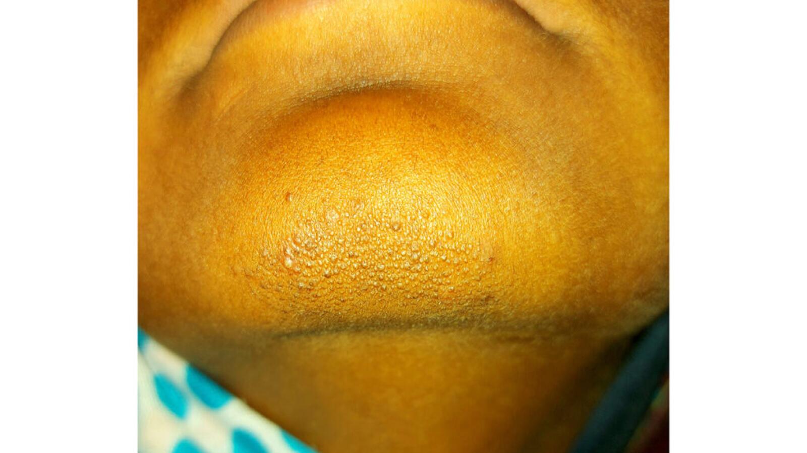 Lichen Nitidus: Symptoms and Treatment