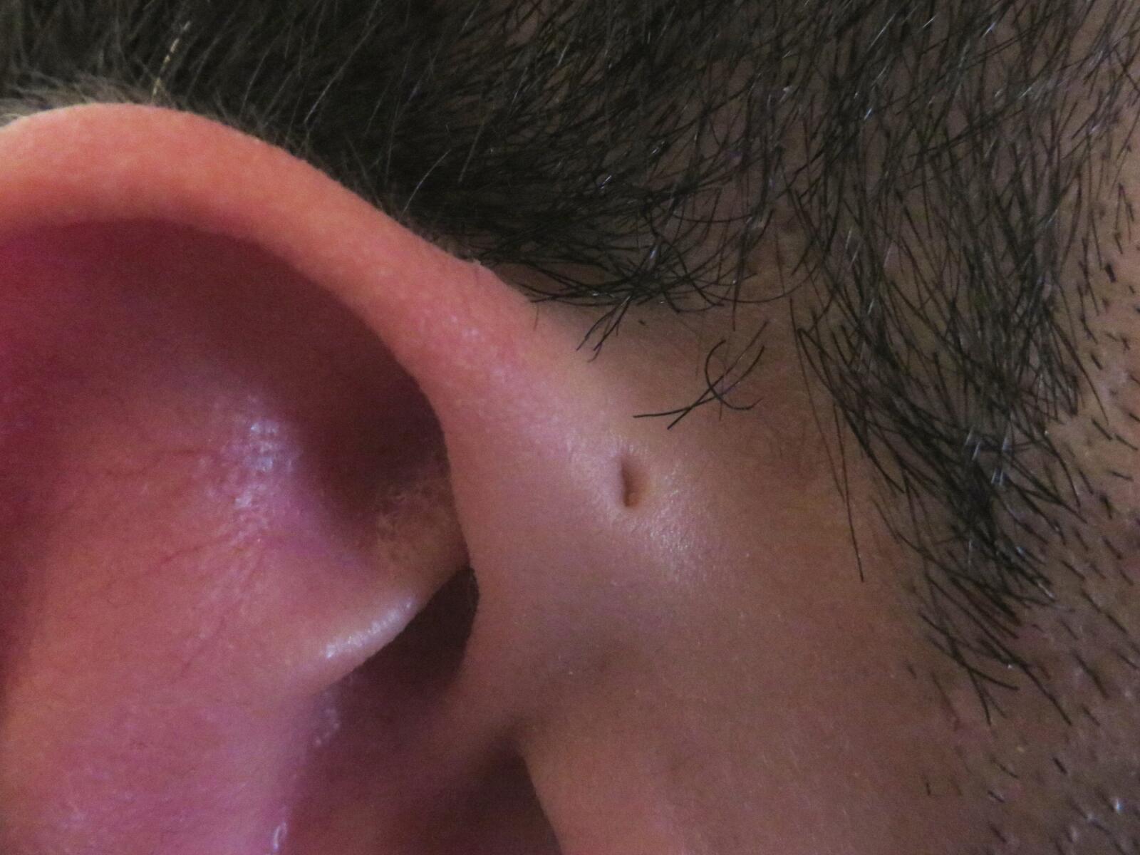 Bump or Lump in or Around the Ear: Causes and Treatments