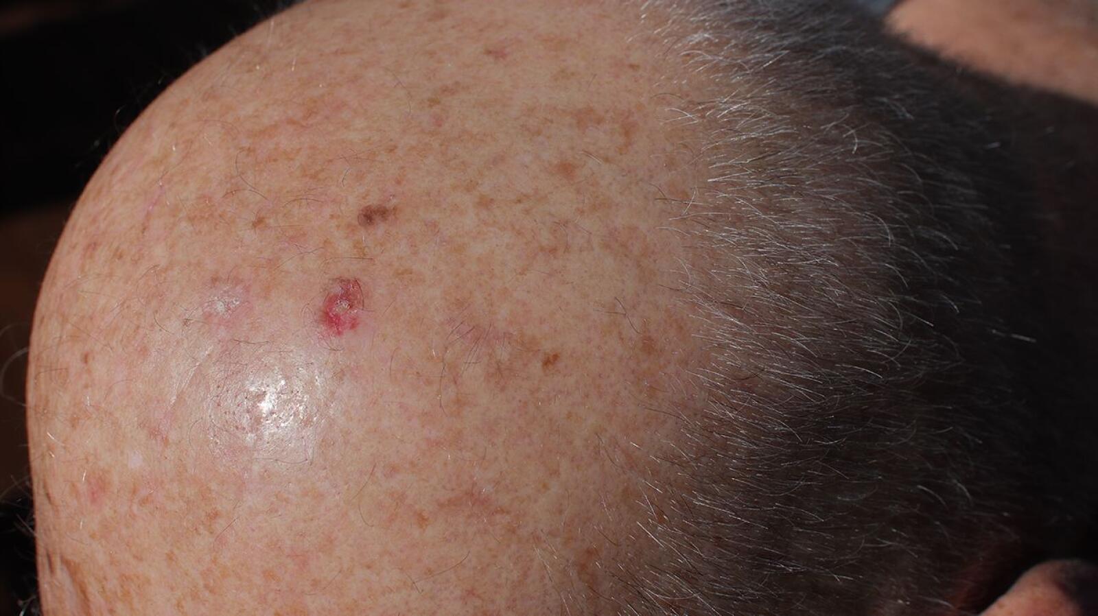Bumps on the Scalp: Pictures, Causes, Treatments