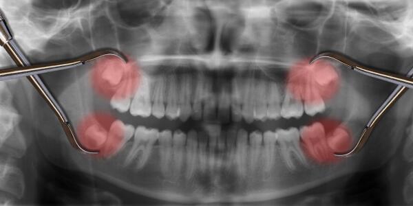 7 Common Types of Oral Surgery | Tooth Extraction, Bone Graft & More