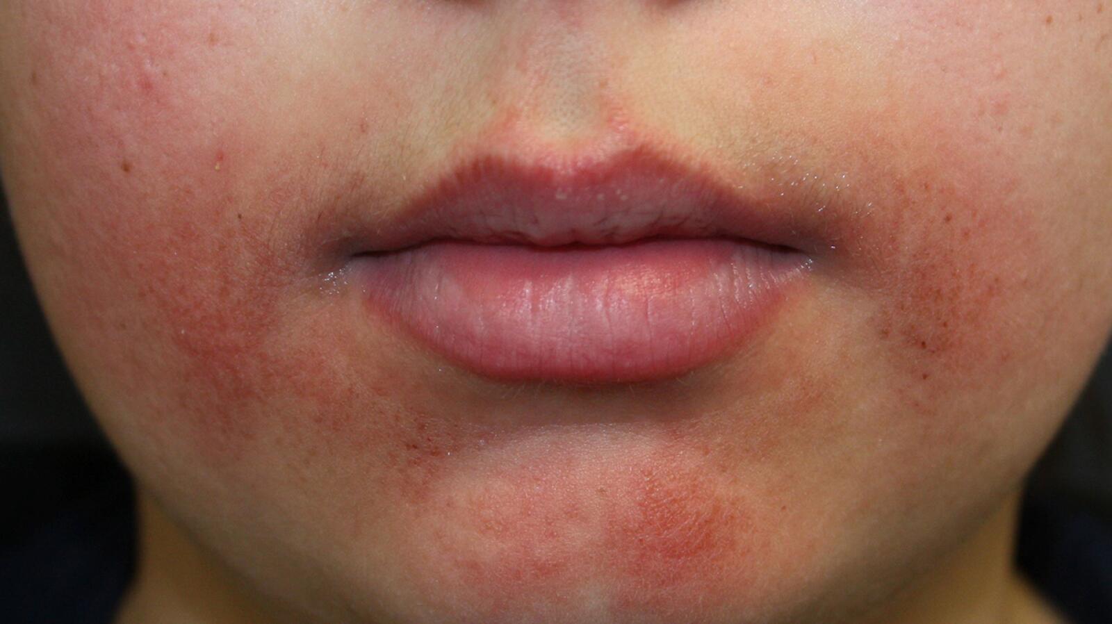 Perioral Dermatitis: Causes, Symptoms, Treatments, and More
