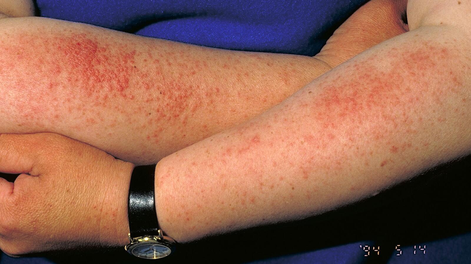 Sun Rash Types Causes And Treatments