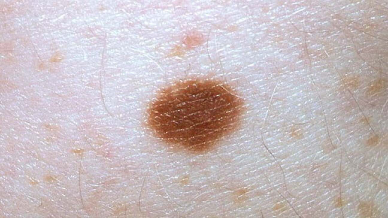Types of Moles with Pictures, Causes, and Treatments