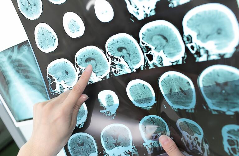 What Does the Temporal Lobe Do? | Temporal Lobe Seizures & Epilepsy