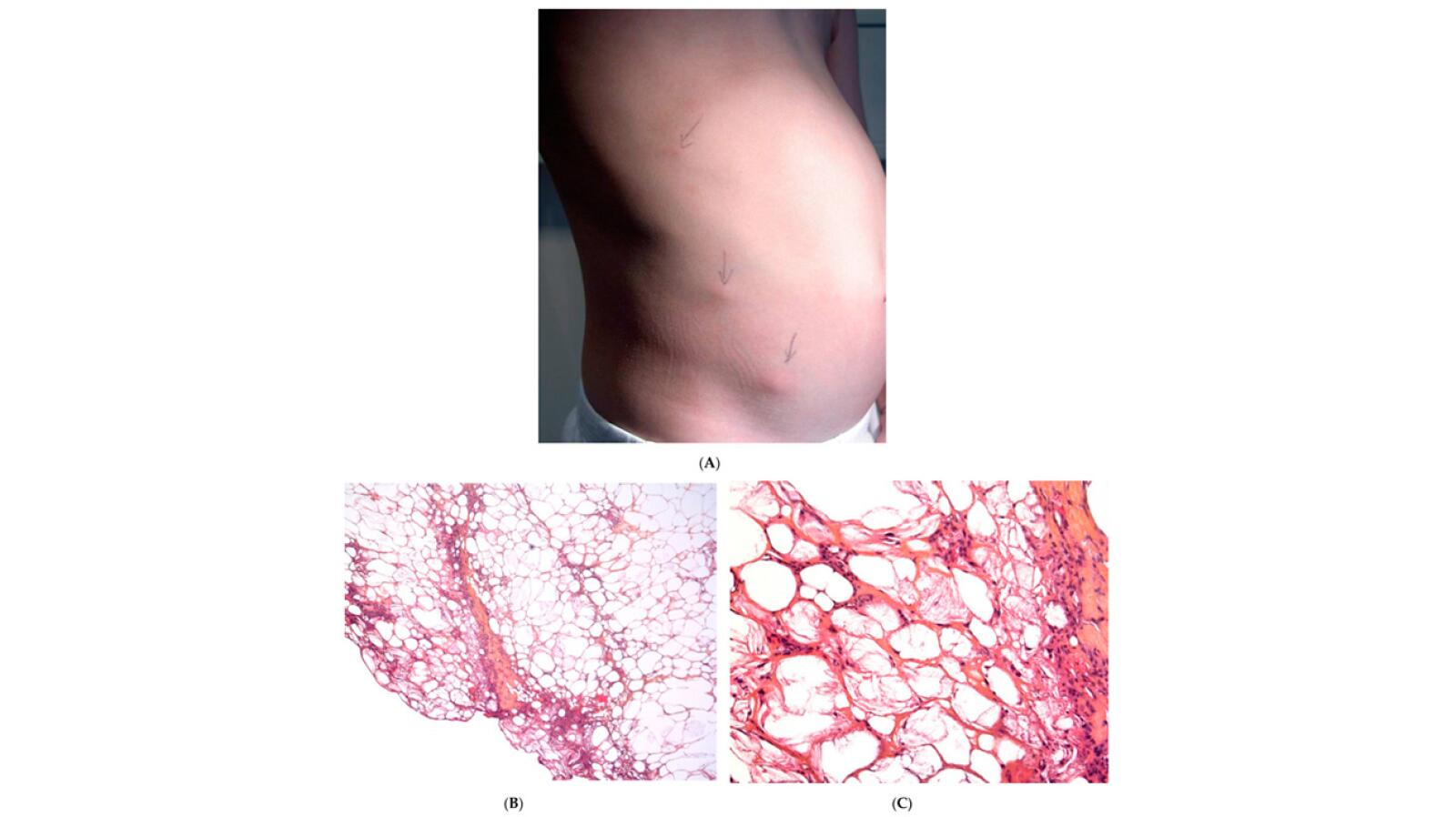 Panniculitis: Types, Symptoms, Treatment, and More