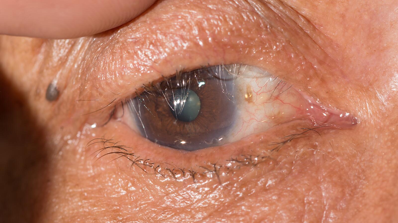 Entropion: Symptoms, Types, Causes, and Treatment