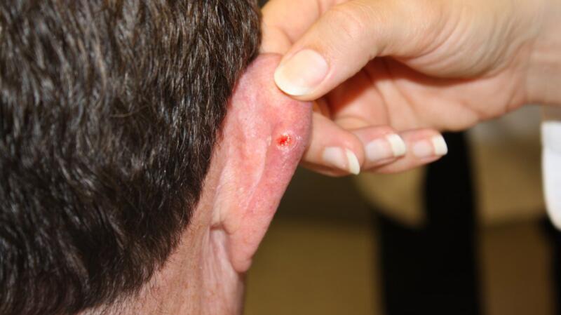 human ear canker