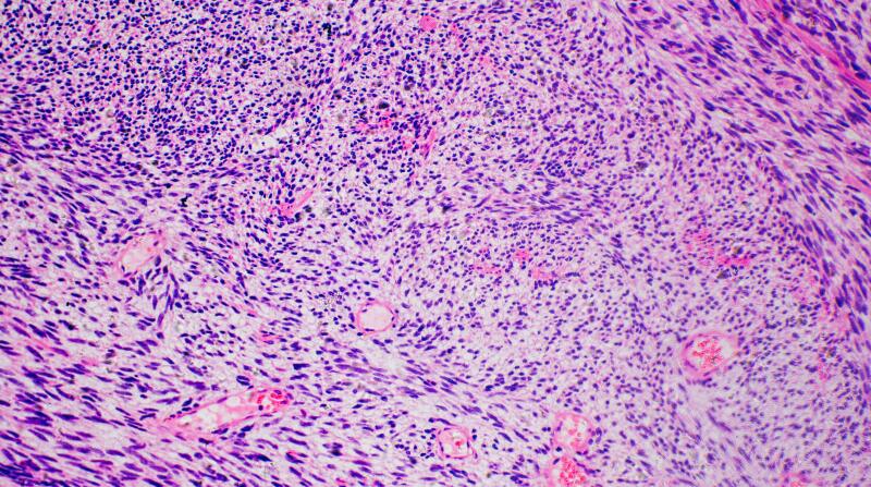 8 Surprising Facts About Soft Tissue Sarcoma
