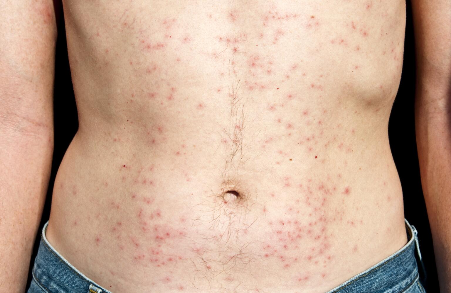 Pseudomonas Infection: Symptoms & Treatment | P. aeruginosa & P ...