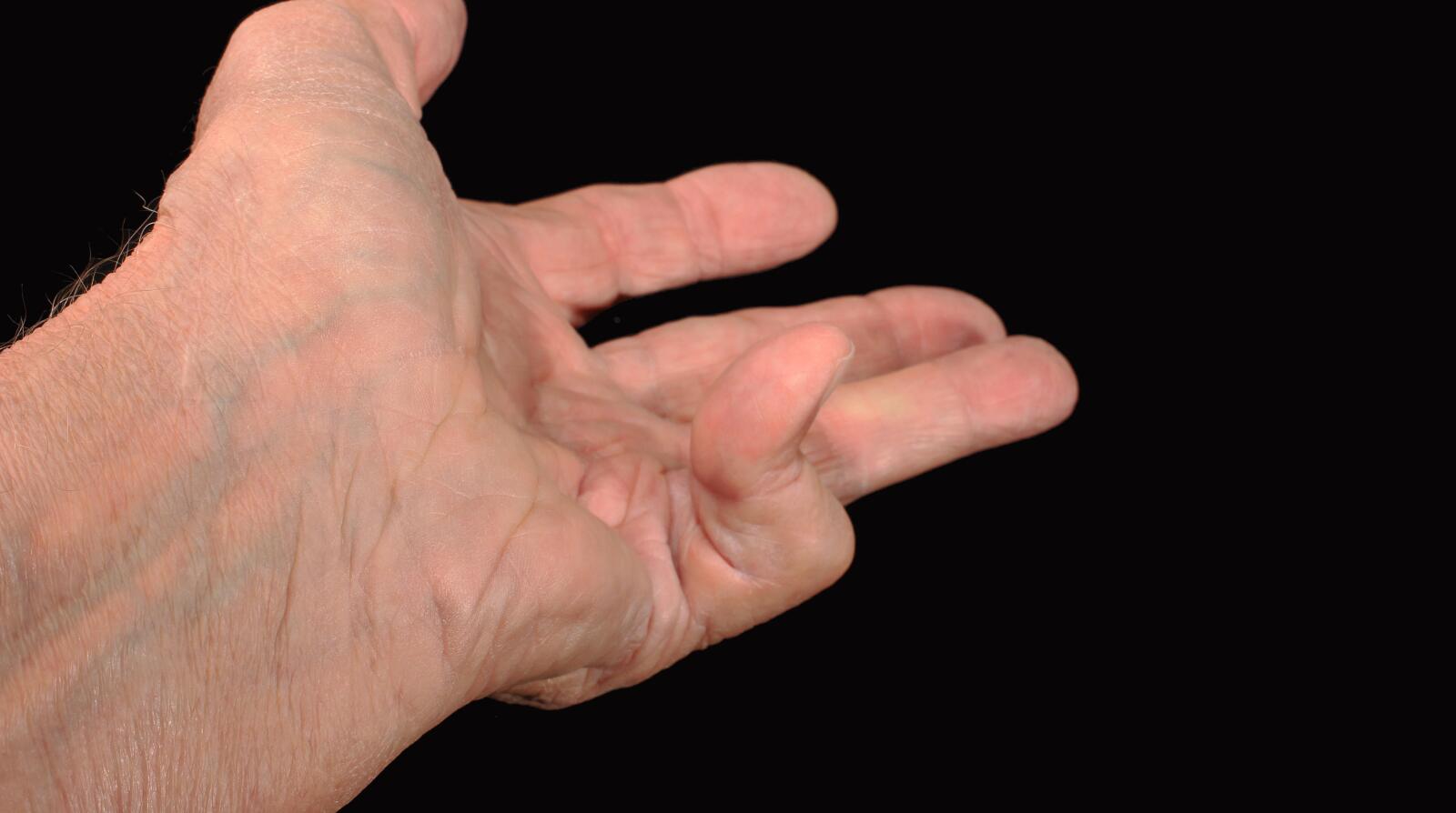 Dupuytren's Contracture: 10 Things Doctors Want You to Know