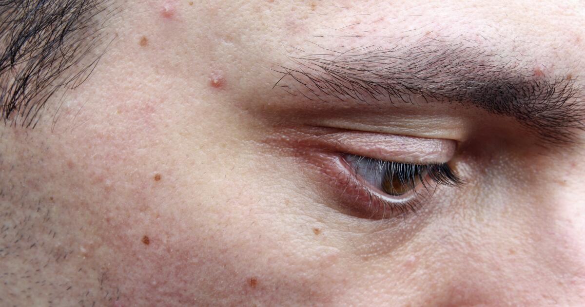 What to Do for Pimples That Don't Go Away