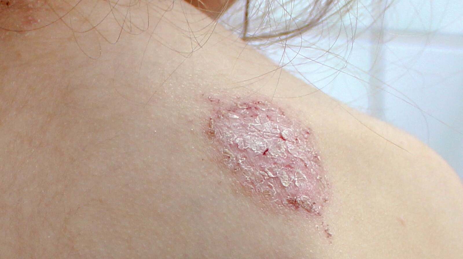 Ringworm vs. Eczema: Symptoms, Causes, Treatments