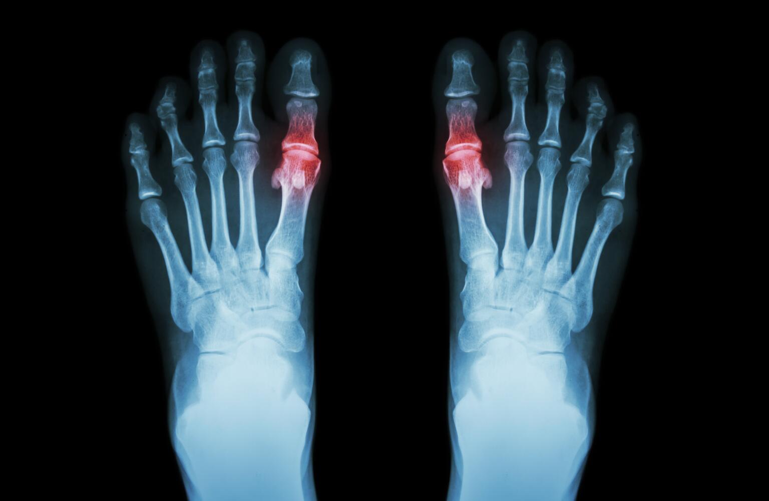 The 4 Stages of Gout