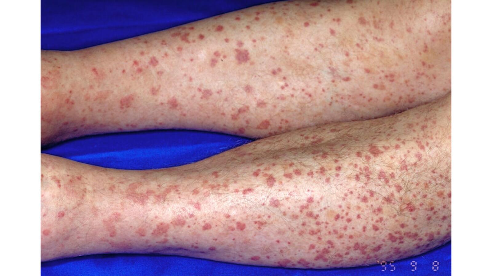 Red Spots on Skin - Causes and Treatment