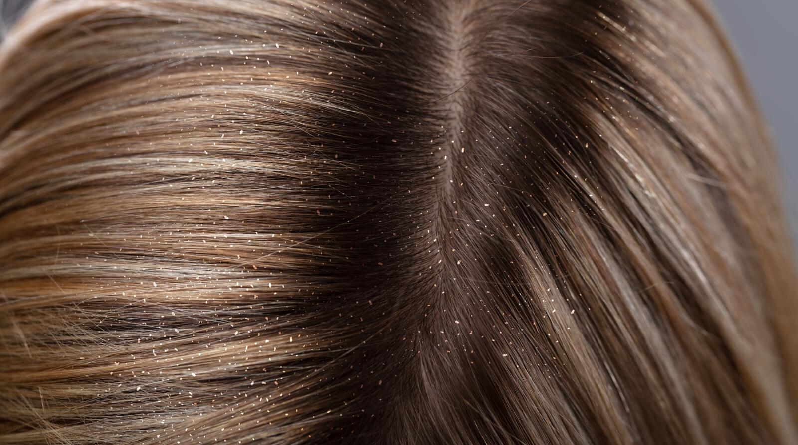 8 Things to Know About Dandruff Causes & Remedies