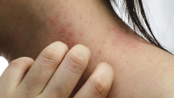 Shingles Symptoms, Prevention & Treatment