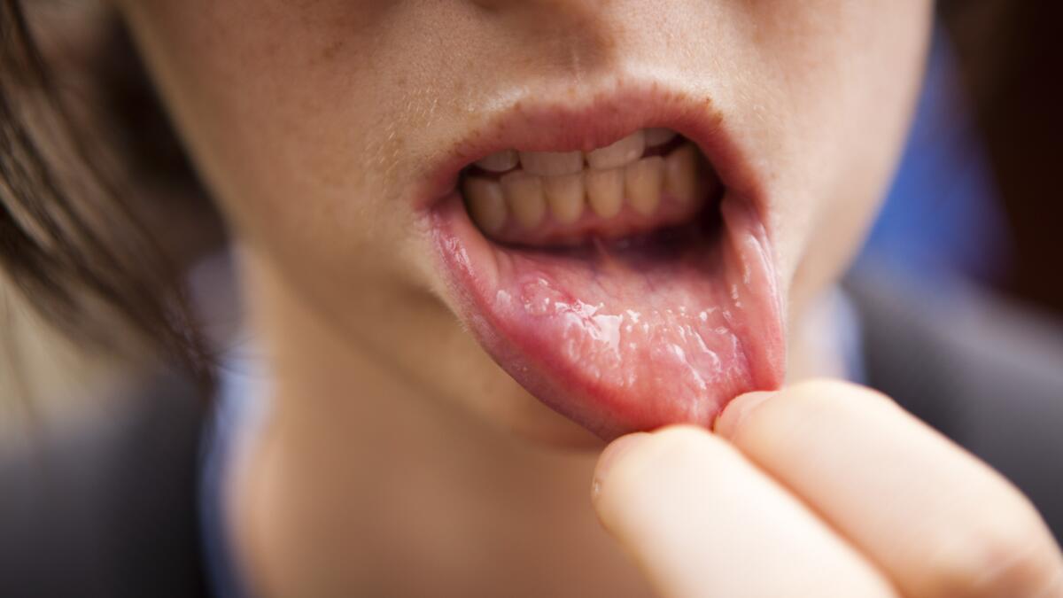 cellulitis inside mouth