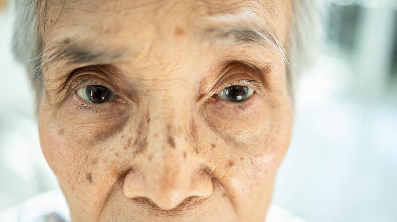 Sunken Eyes: Causes, Appearance, Treatments, and More