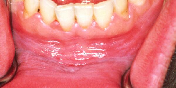 Mouth Cancer Pictures | What Oral Cancer Sores Look Like