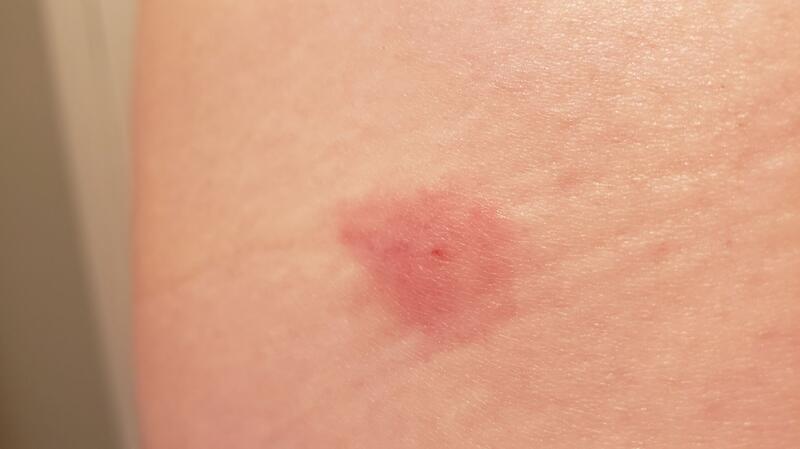 Horsefly Bite: Symptoms, Pictures, Treatment, and More