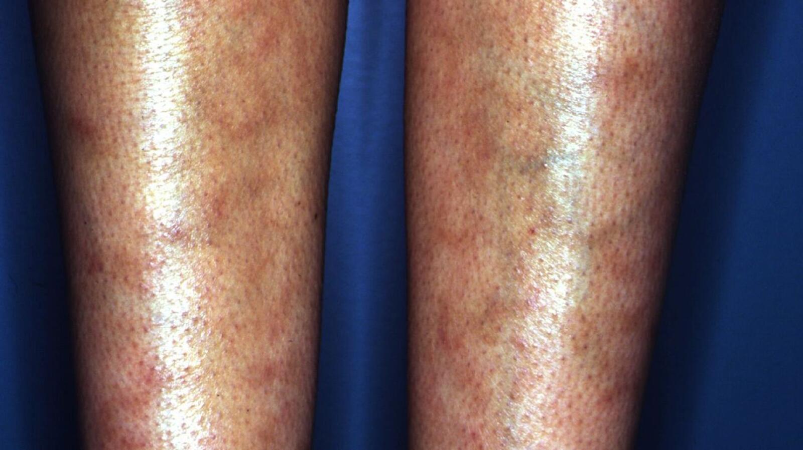 Rash on Stomach: Causes, Symptoms, and Treatment