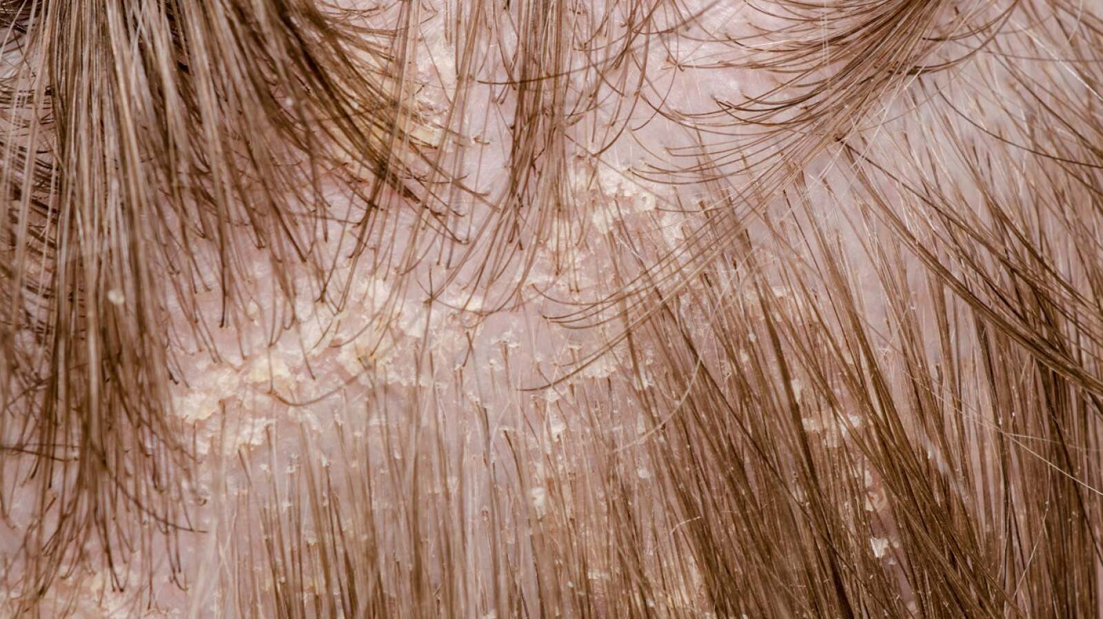 Dandruff Vs Dry Scalp Causes Treatment And Main Differences