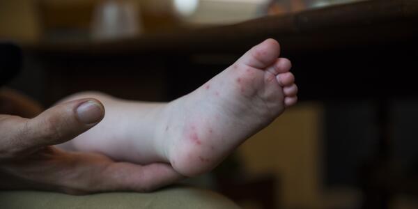 7 Types of Foot Rashes & How to Treat Them | Causes of Foot Rash