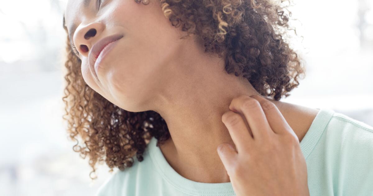 What Does Hives Look Like On Skin of Color | Hives on Darker Skin Tones