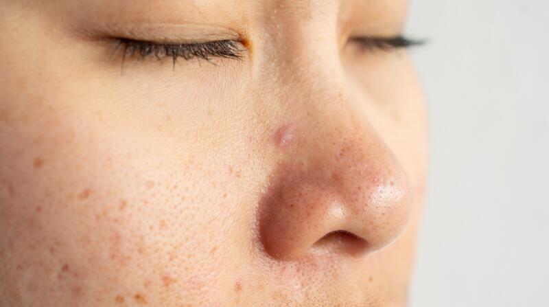 Stress Hair Loss | Stress Rash | Effects of Stress on Skin