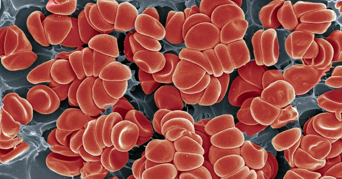 Blood Clots - Symptoms, Causes, Treatments