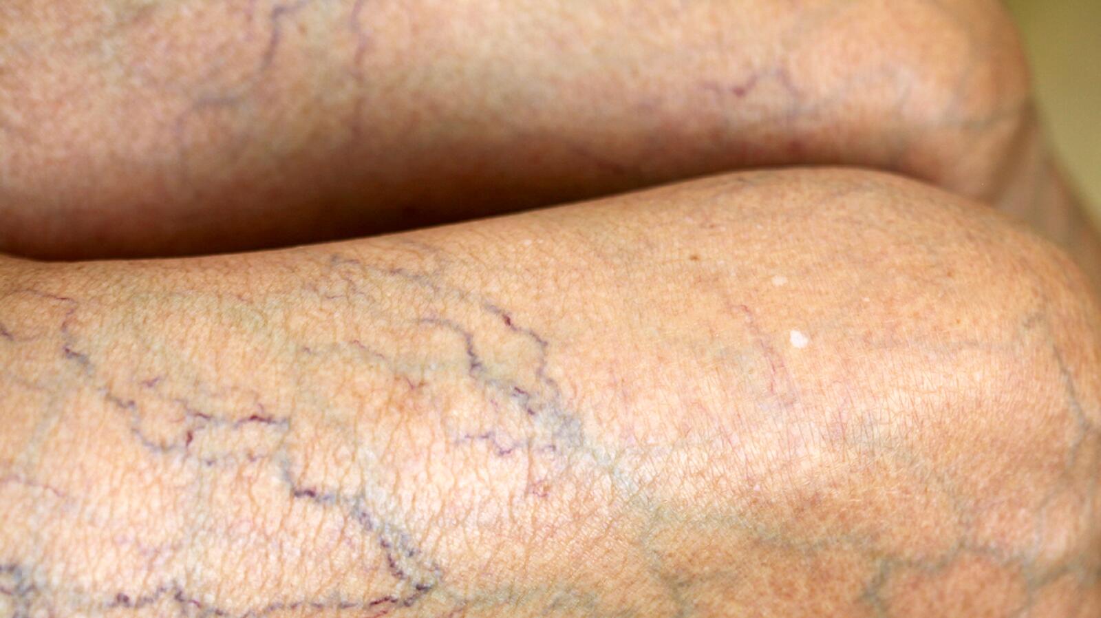 Venous Insufficiency: Early Signs, Causes, Treatment, and More