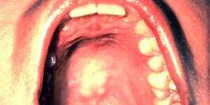 white spot on tongue cancer