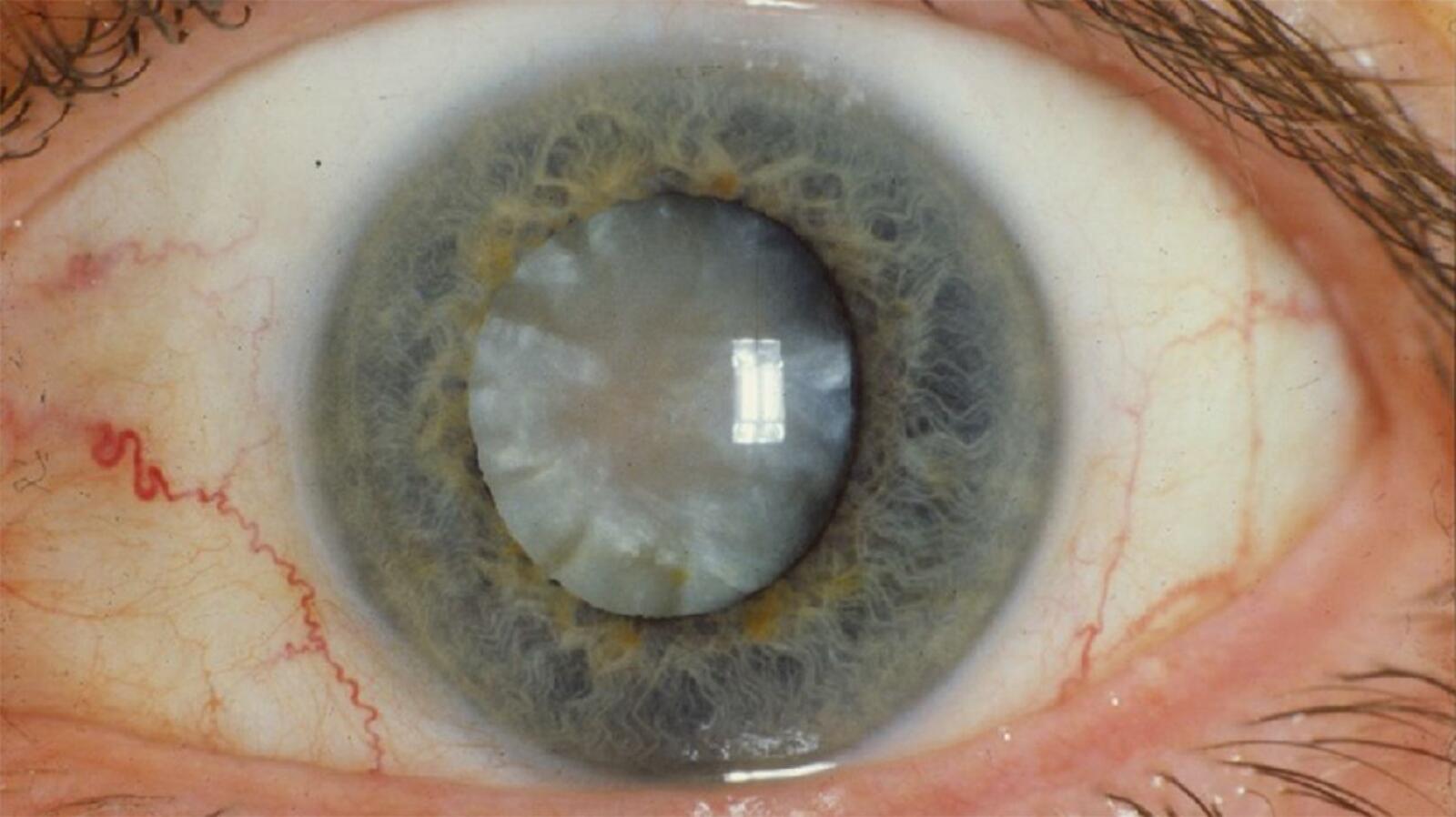 What Is a Nuclear Cataract? Symptoms, Causes, and Treatment