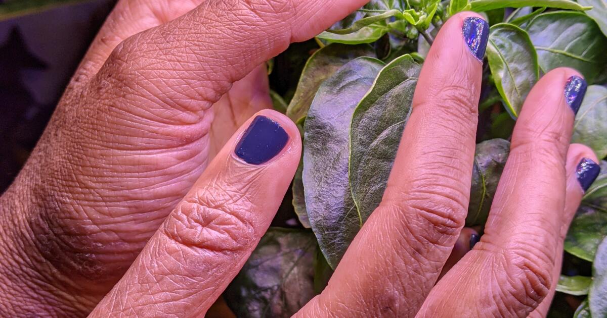 Hand Eczema: Tips for Soothing Flares From Handwashing