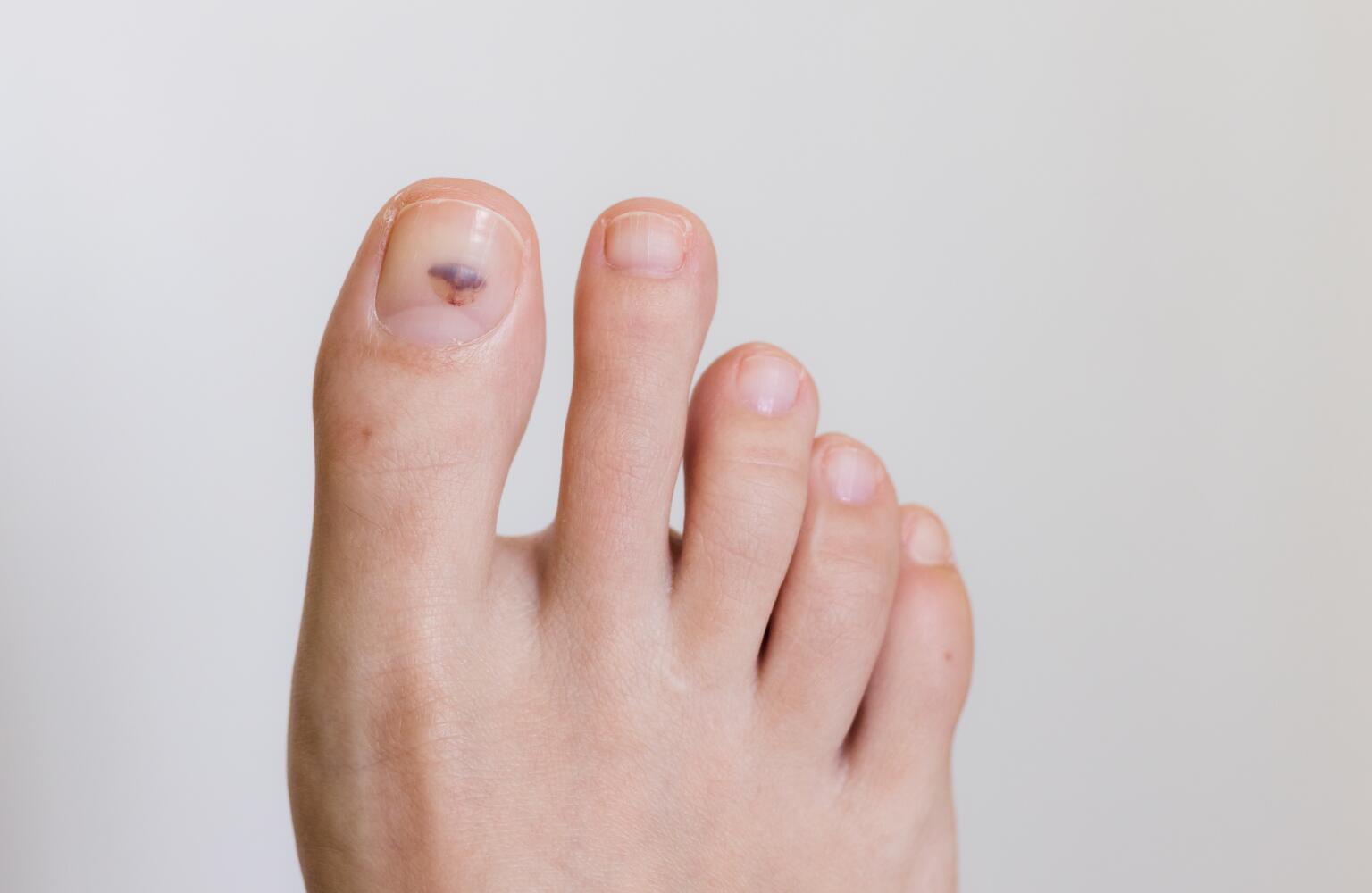 Toenail Problems: Fungus, Thickening & Yellow Toenails