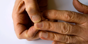 7 Places Where You Can Get Ringworm (Tinea) | Athlete’s Foot & More